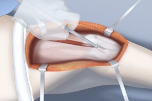 Surgery For Recurrent Patella Dislocation – Dr. Ameya M. Sawarkar